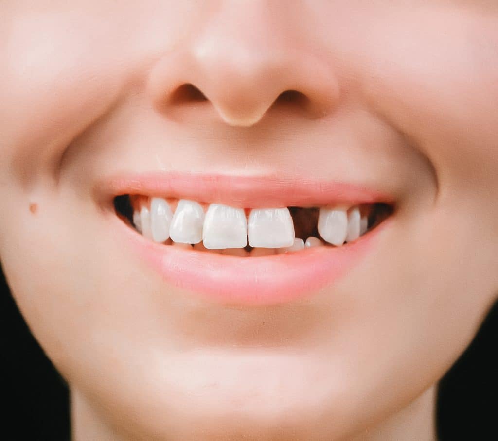 What to Do If You Lose a Tooth In Conroe | Conroe, TX