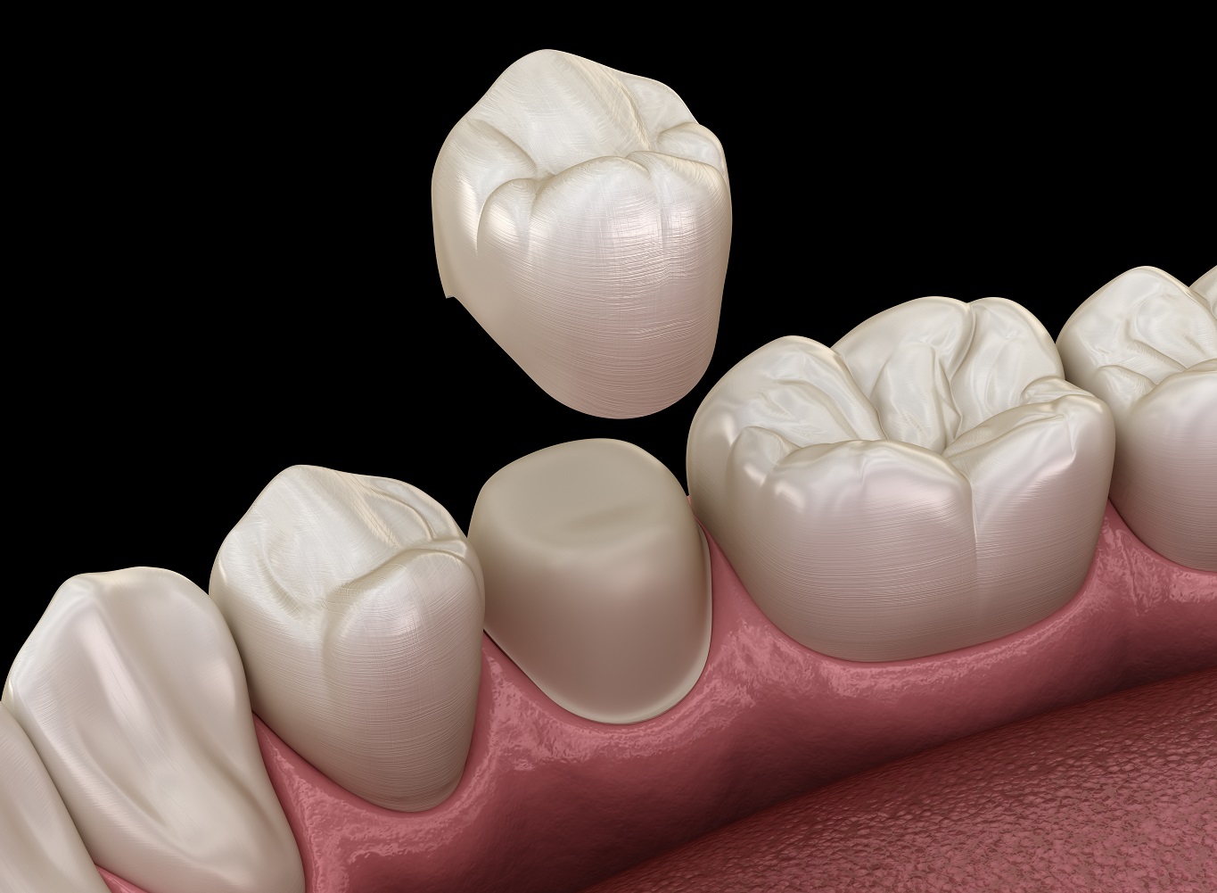 Some of the Best Reasons to Put a Crown on a Tooth | Conroe, TX