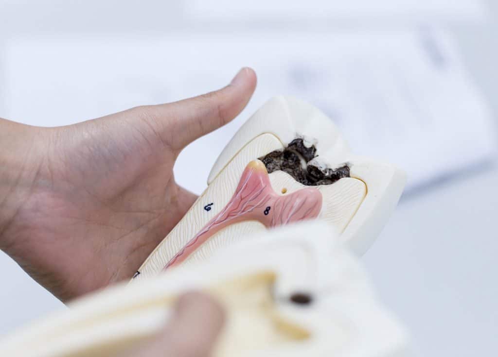 What’s the Worst-Case Scenario for Your Tooth Decay? | Conroe, TX