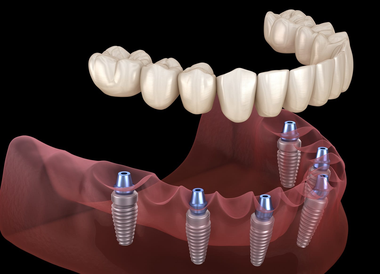 How to Improve the Quality of Your Custom Denture | Conroe, TX