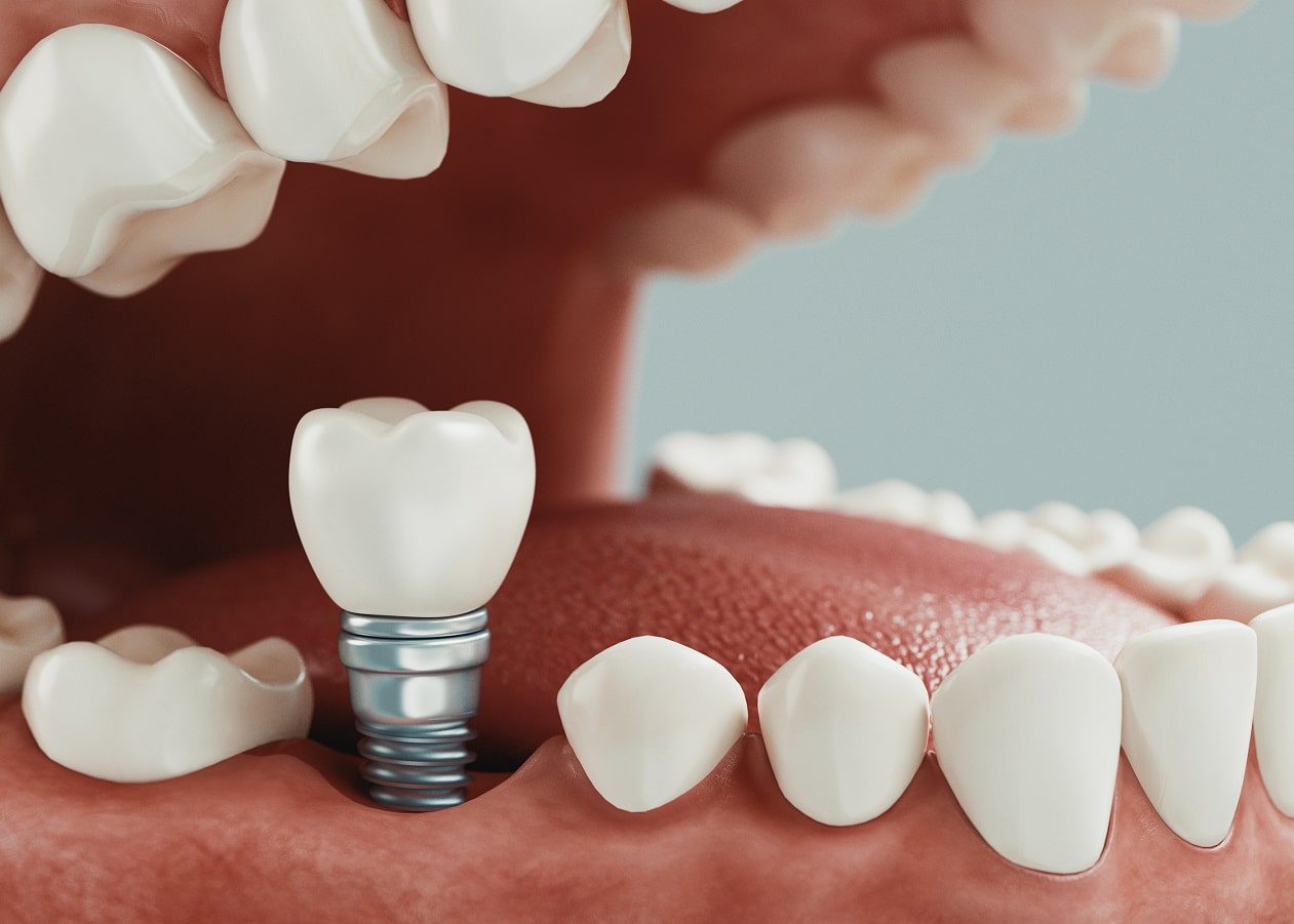 Important Things About Dental Implant Restorations | Conroe, TX