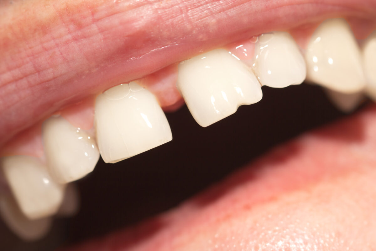 A Damaged Tooth Is A Dental Emergency | Conroe, TX